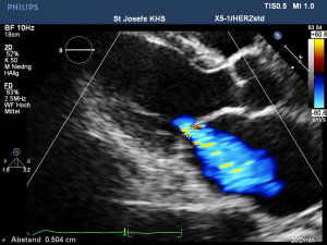 Ergänzungen (1/5) neue ASE-Leitlinien zu Klappeninsuffizienzen ...
